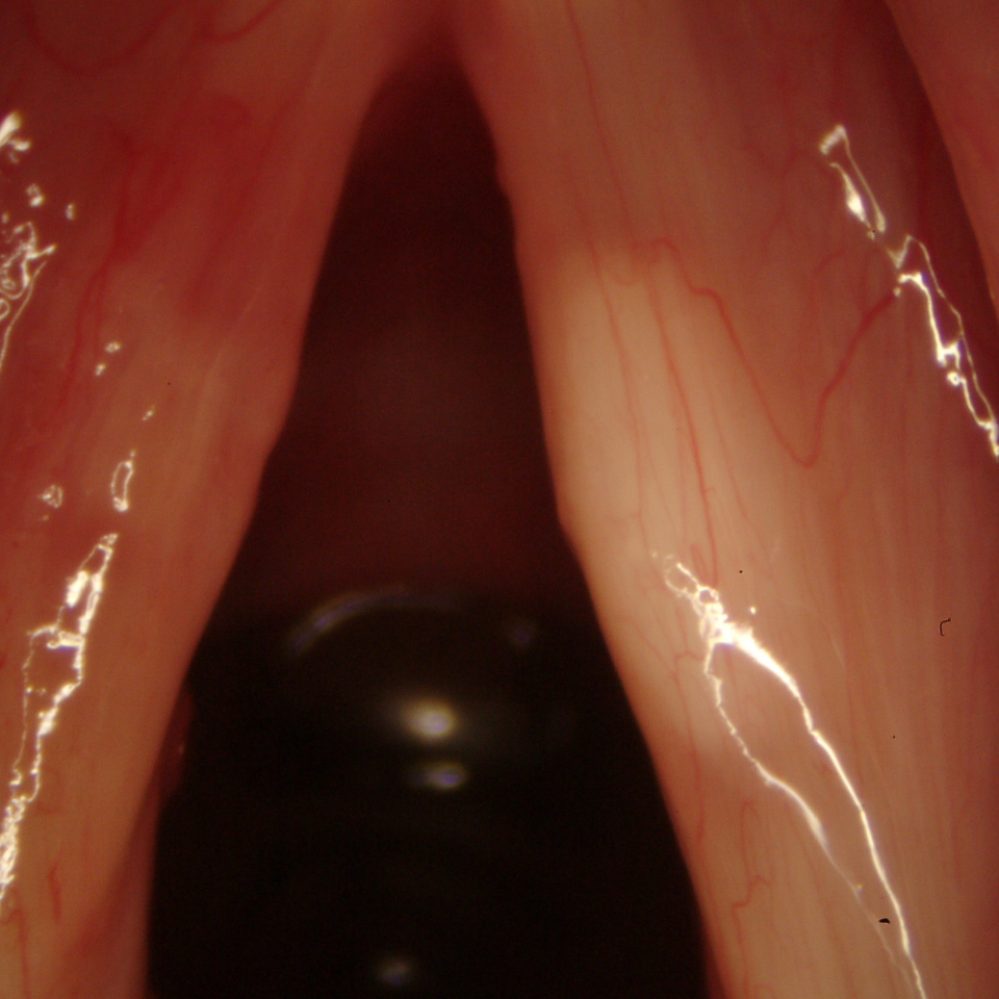 Conditions of the Larynx | Peak Woo MD PLLC