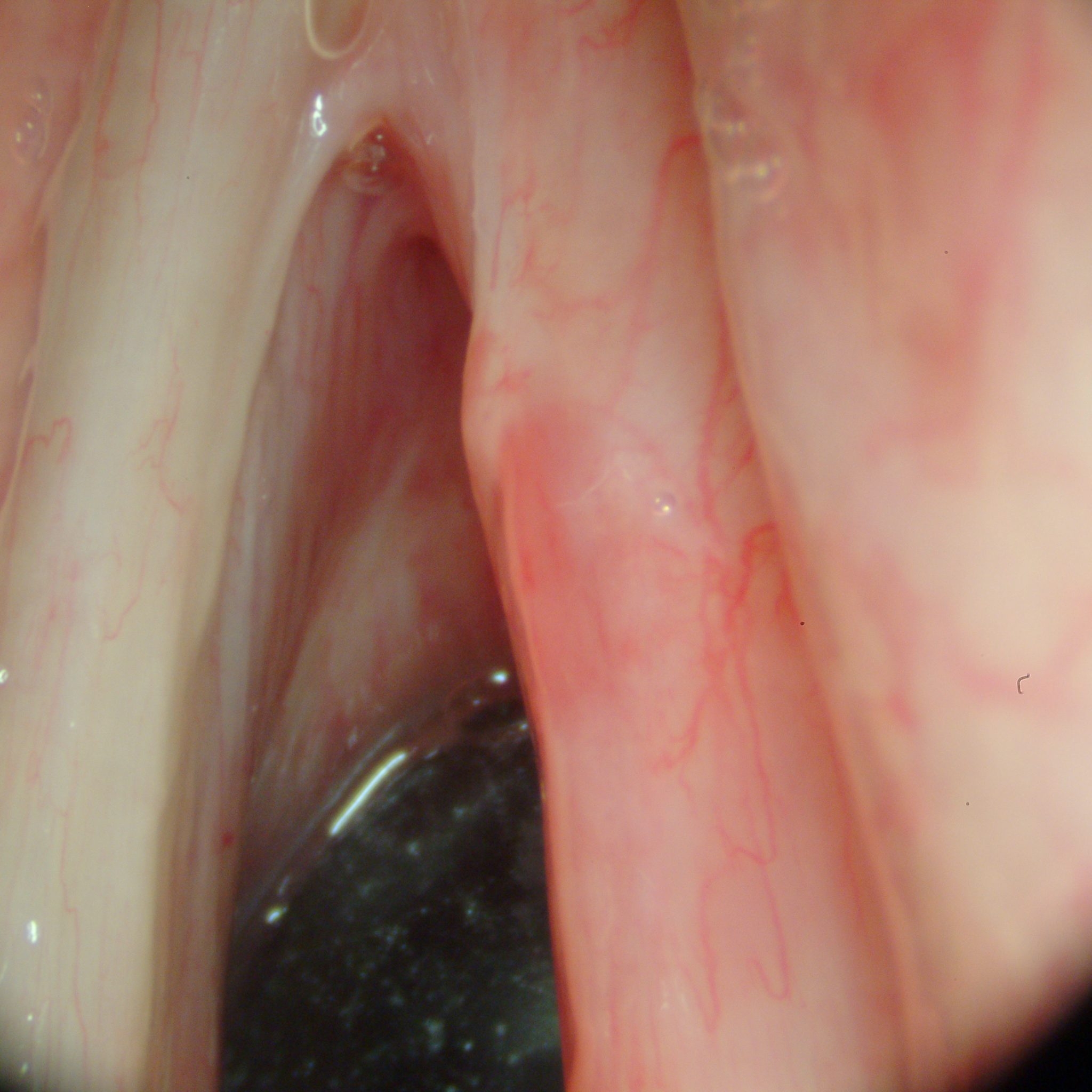 Conditions of the Larynx | Peak Woo MD PLLC