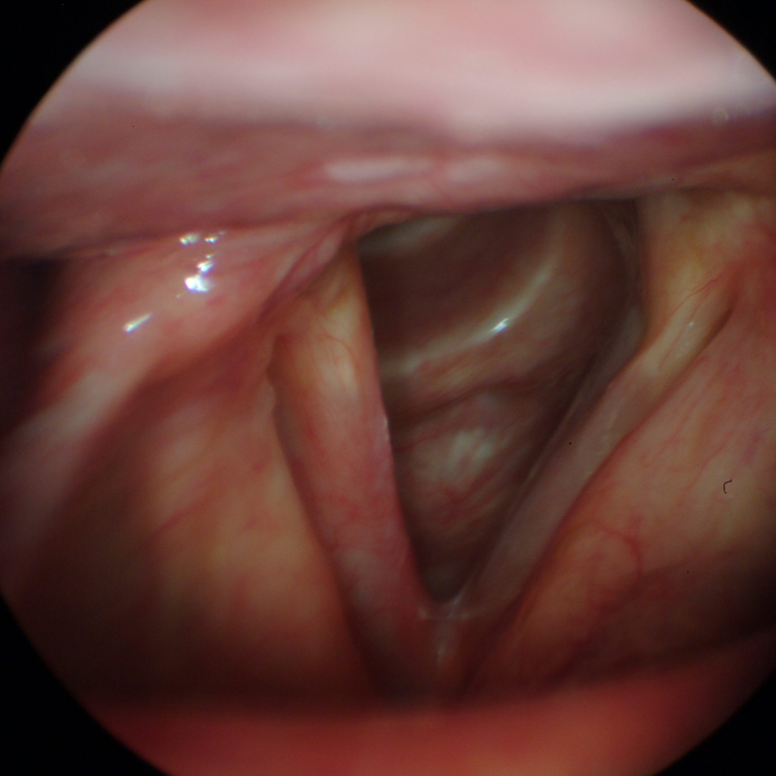 Conditions of the Larynx | Peak Woo MD PLLC